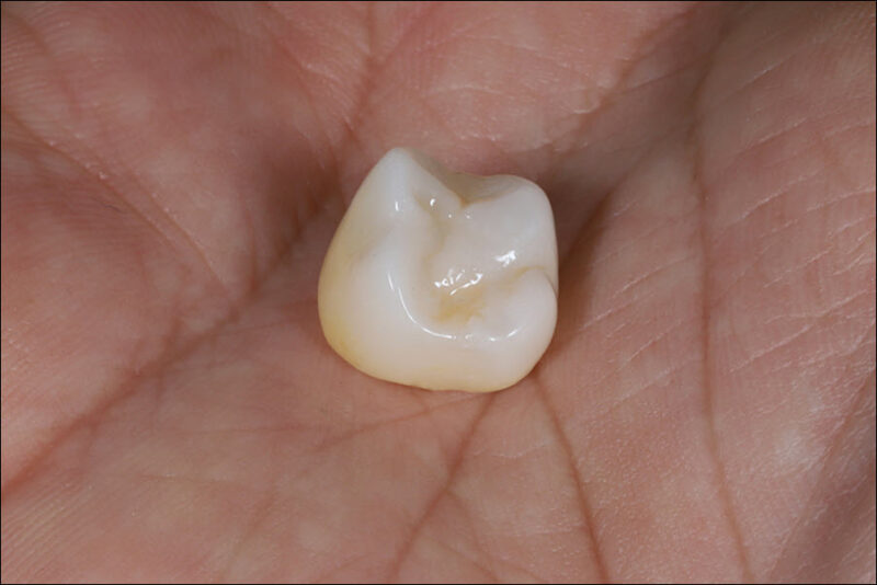 Dental Crowns | Poplar Square Dental, Camp Hill PA - Poplar Square Dental